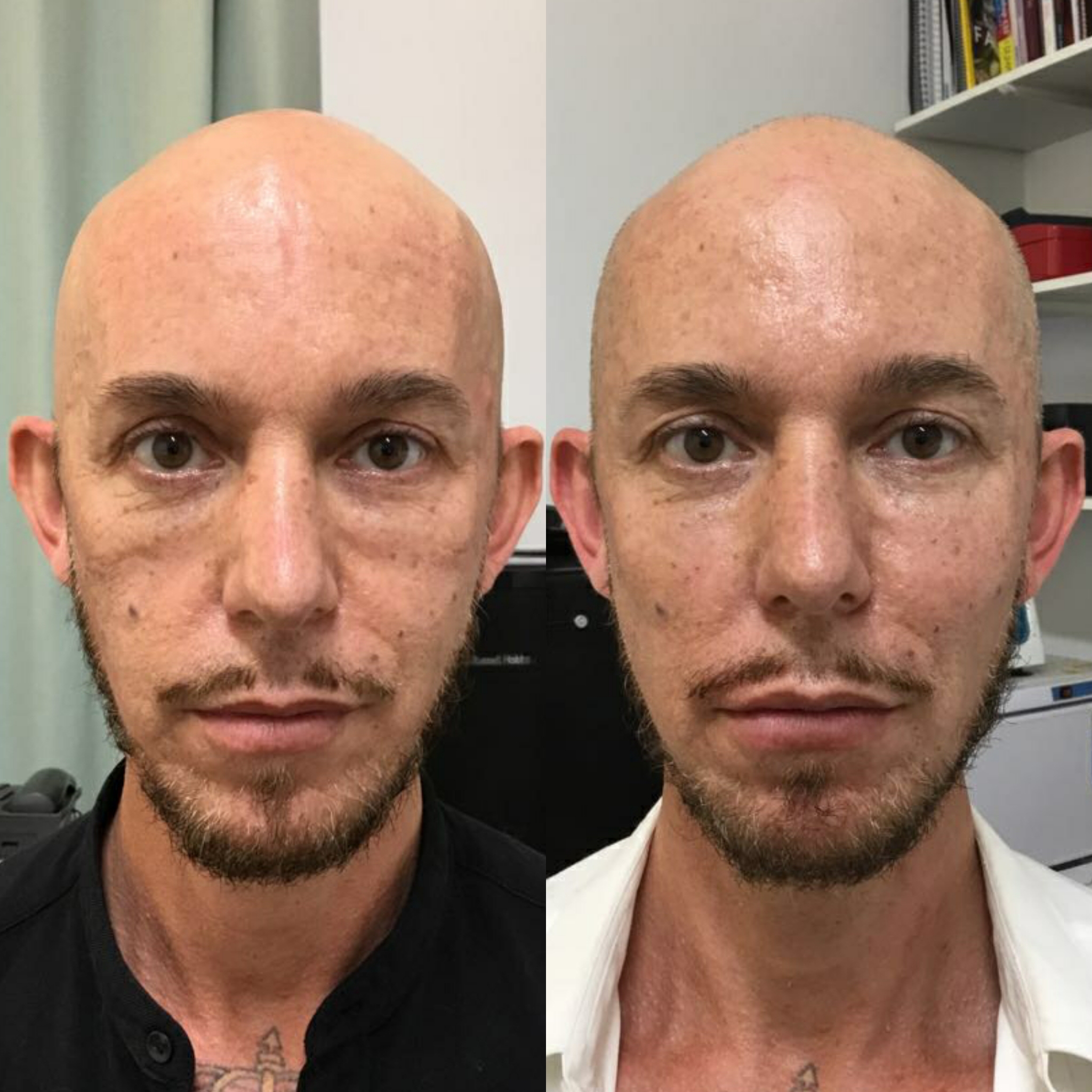 Male Dermal Filler Injections - Men's Facial Fillers - Harley St ...